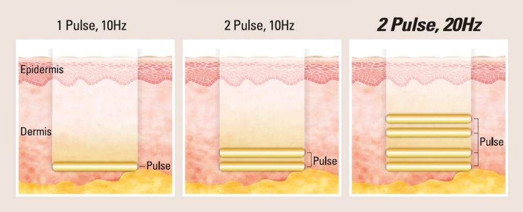 tri-beam-diagram – The Global Beauty Group